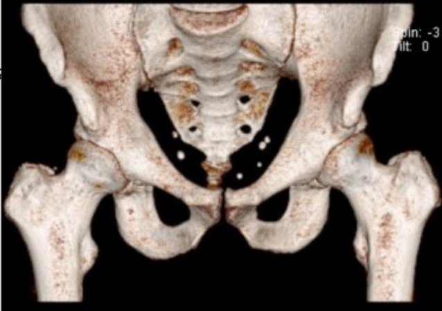 CT & Motion Analysis | Giles Stafford Consultant Orthopaedic Hip Surgeon